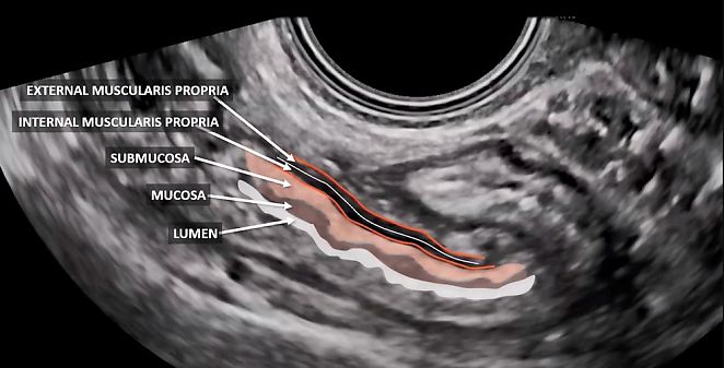 Uterus Anatomy Ultrasound Female Ultrasound Phantom Vaginal Training